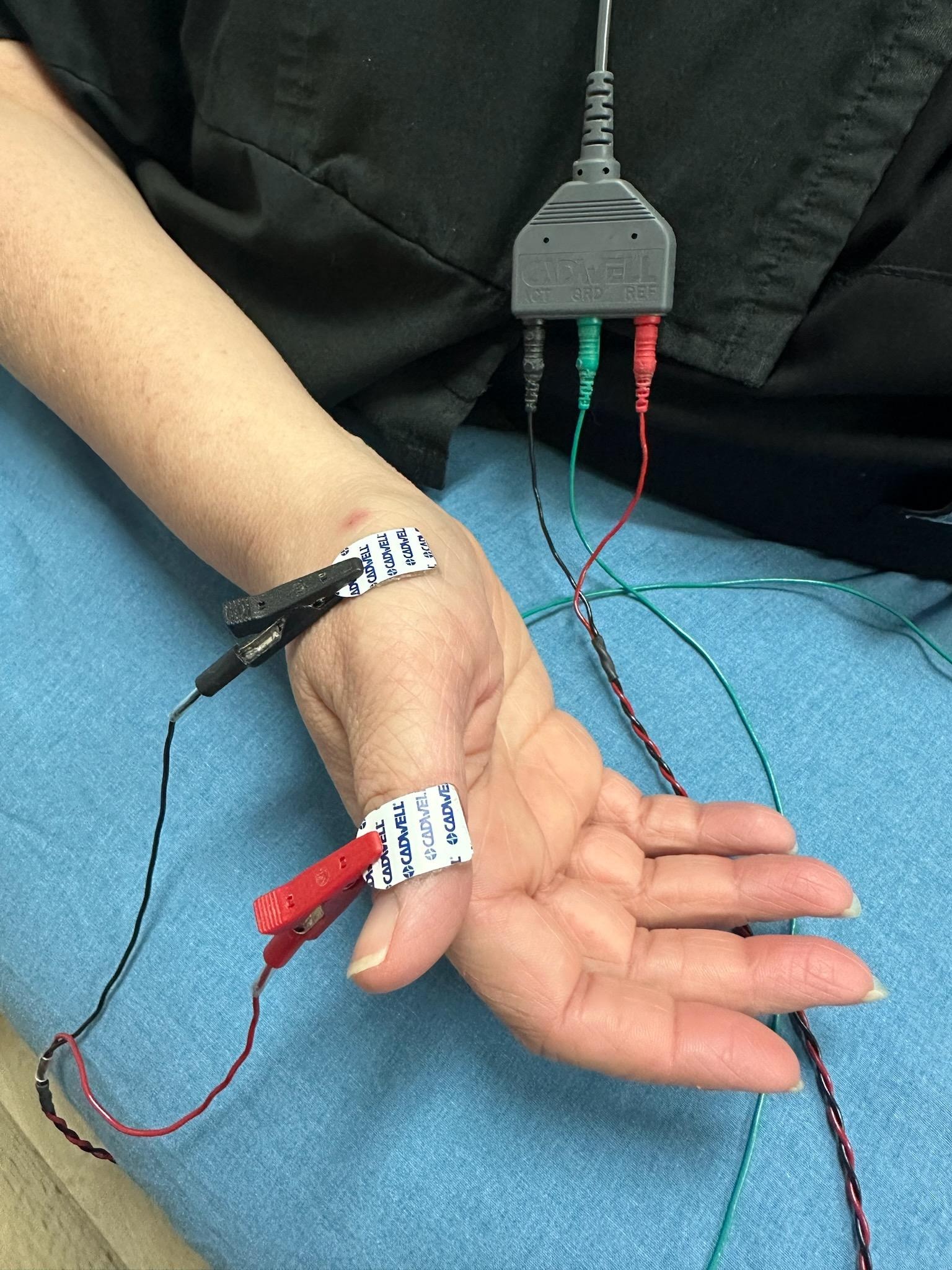 Houston EMG | Electromyographies/Nerve Conduction Studies in North ...